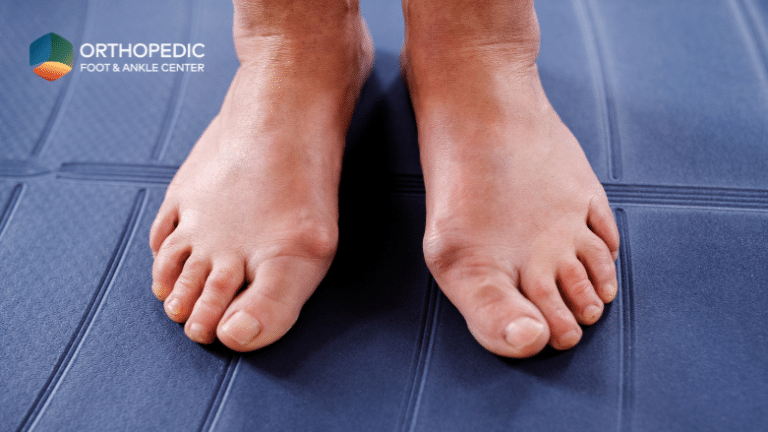 Bunion Treatment in Columbus, OH