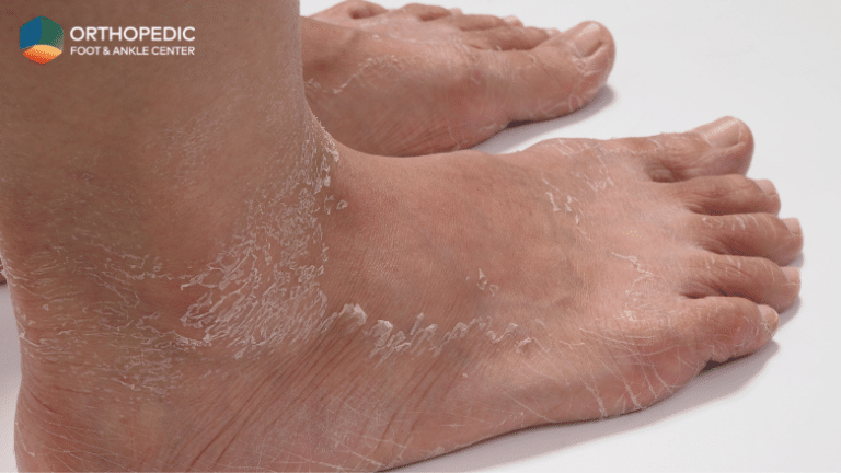 Athlete's Foot Treatment in Columbus, OH