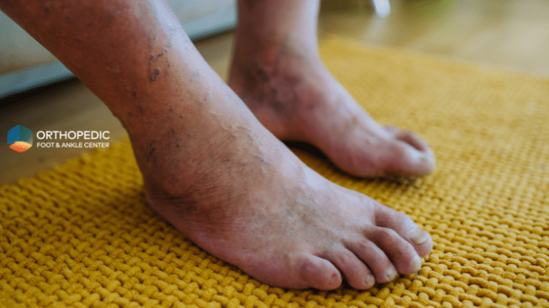 Diabetic Charcot Treatment - Greater Columbus, Ohio