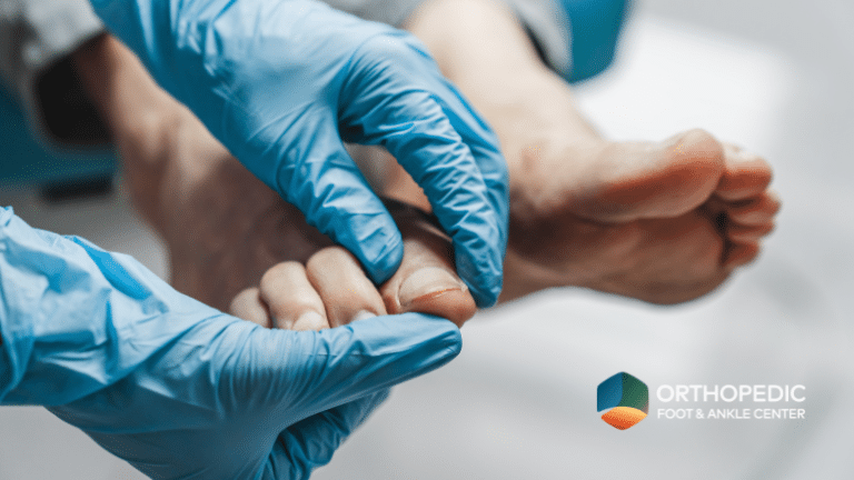 Overlapping Toes - Columbus, OH - Orthopedic Foot & Ankle Center